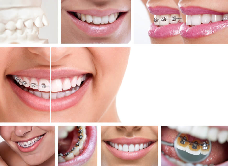 Clear Alignment Braces - Robert Perry Dental